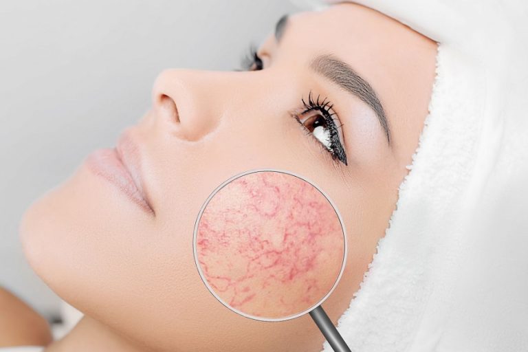Thread and spider veins - Castleknock Cosmetic Clinic